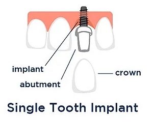 Single Tooth Implant Cost - EON Clinics